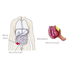 Blinddarm